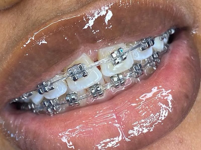 Cheapest Braces in Uganda: Costs, Options, and What to Know